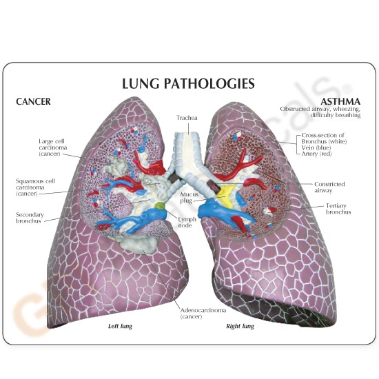 LFA #3110 COPD LungCOPD Lung Anatomical Model Set with Pathologies Set ...