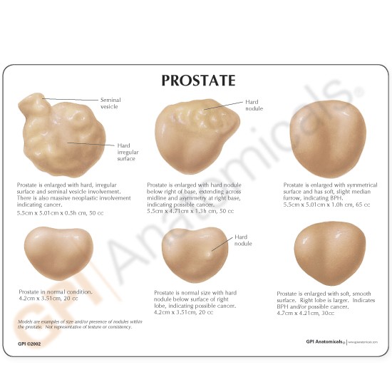 Prostate Gland Size Chart Greenbushfarm Prostate Gland Size Chart Greenbushfarm